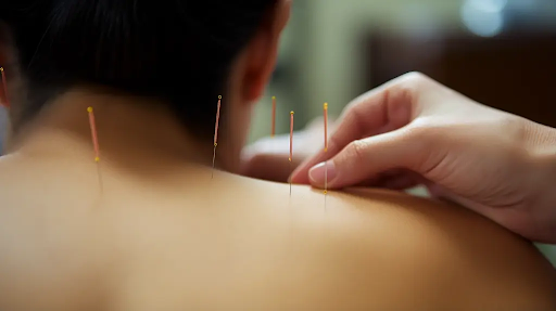 Acupuncture Therapy: Benefits, Risks & How It Works - Cho Acupuncture ...